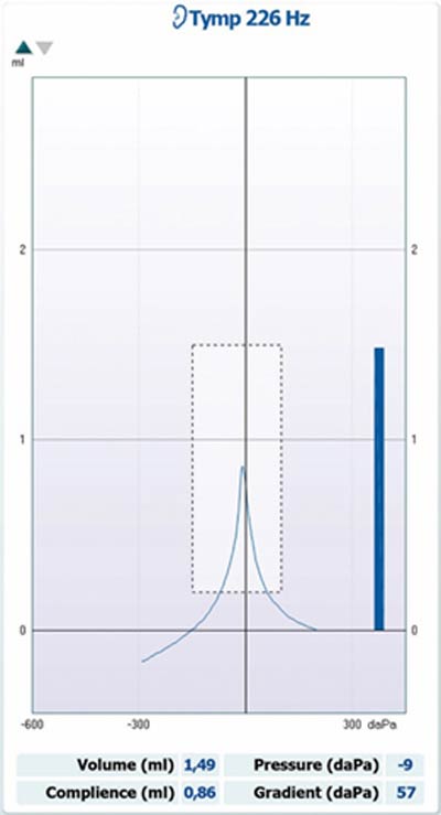Understanding Tympanometry: A Comprehensive Guide