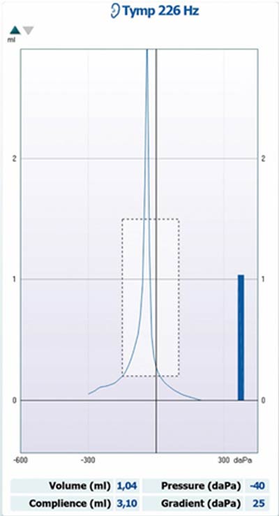 Understanding Tympanometry: A Comprehensive Guide