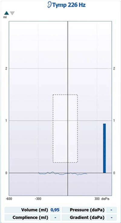 Understanding Tympanometry: A Comprehensive Guide