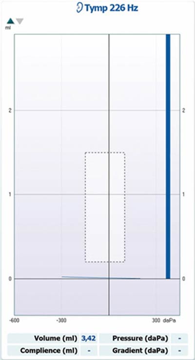 Understanding Tympanometry: A Comprehensive Guide